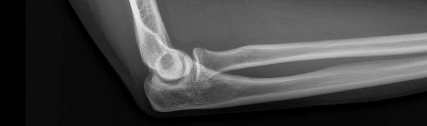 Elbow Surgeon Detroit - Ben Mayo, MD